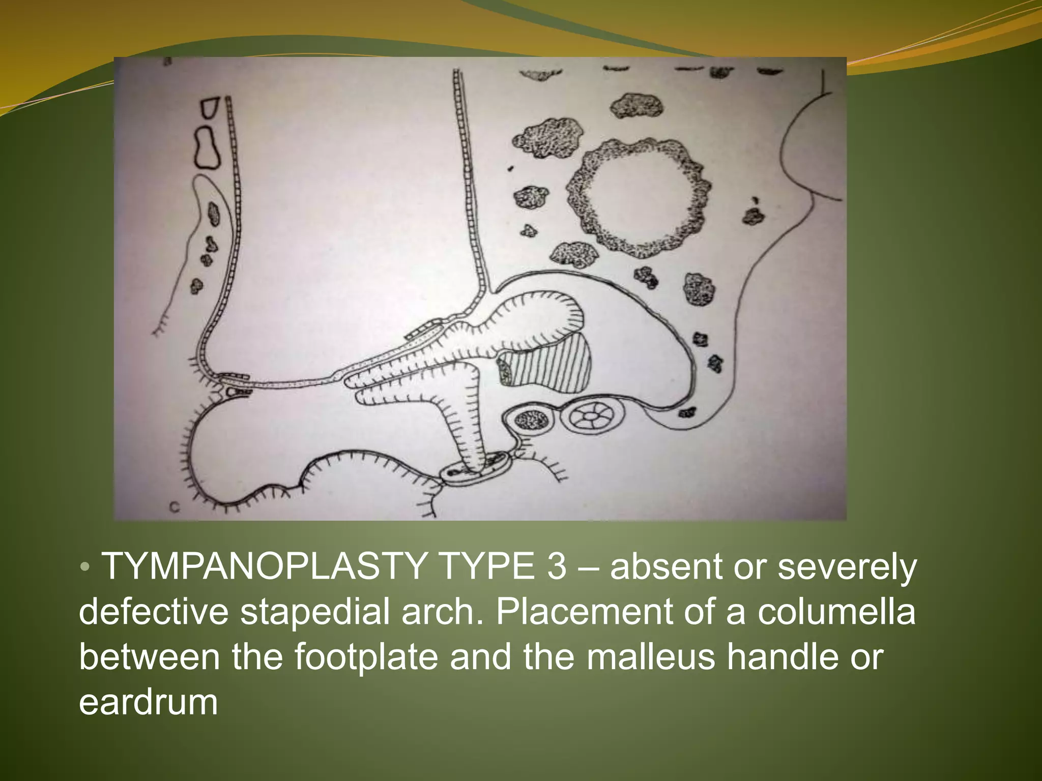Tympanoplasty; Indications, types, anesthesia, surgical procedure. | PPT