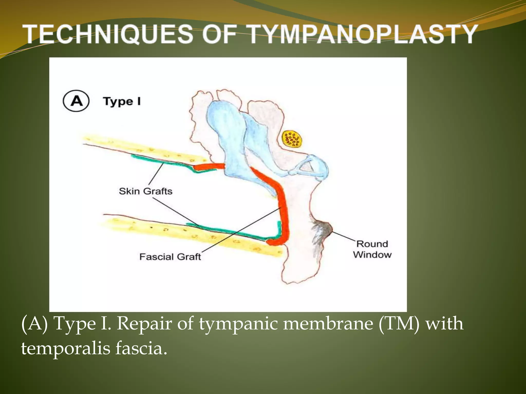 Tympanoplasty; Indications, types, anesthesia, surgical procedure. | PPT