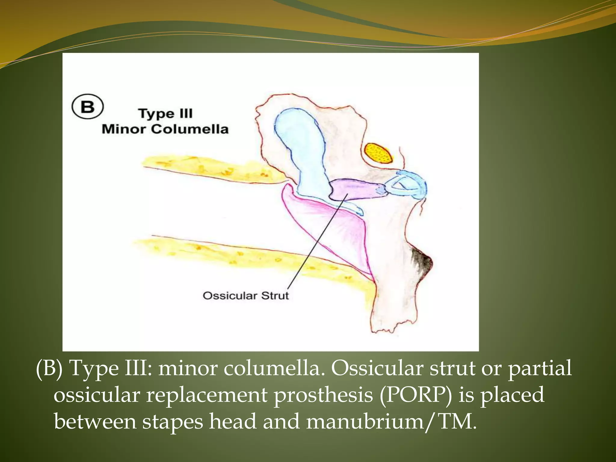 Tympanoplasty; Indications, types, anesthesia, surgical procedure. | PPT
