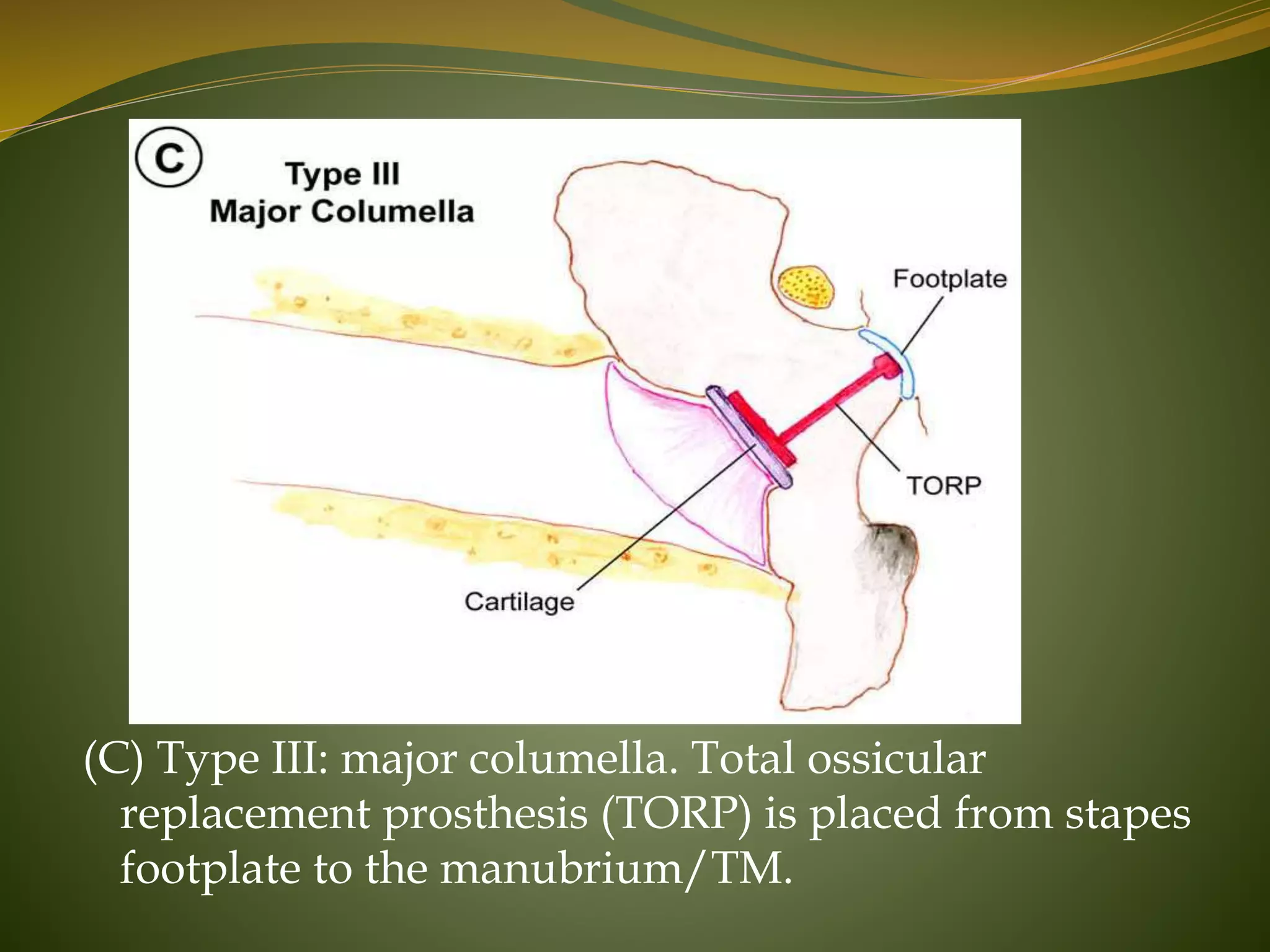 Tympanoplasty; Indications, types, anesthesia, surgical procedure. | PPT