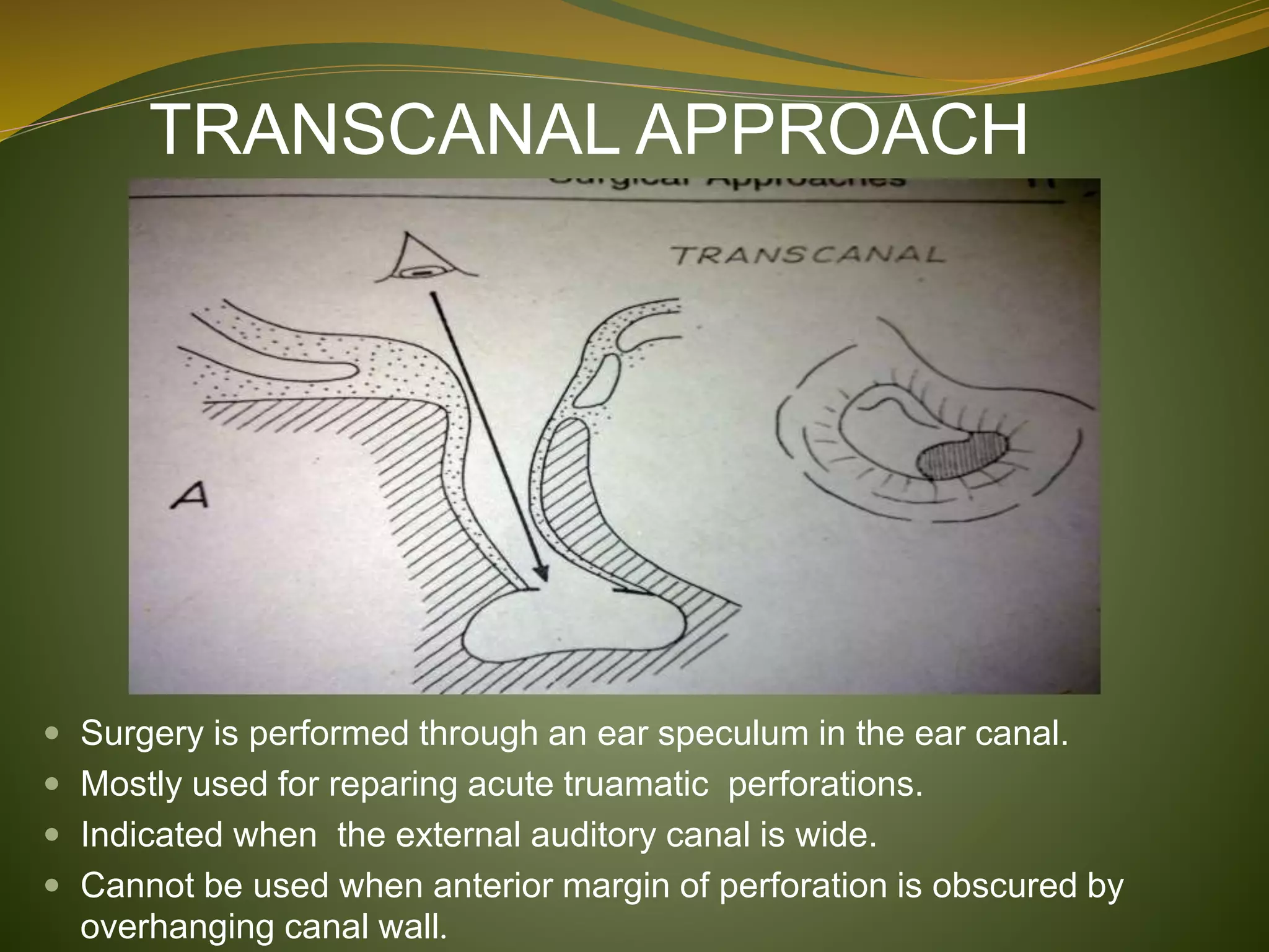 Tympanoplasty; Indications, types, anesthesia, surgical procedure. | PPT