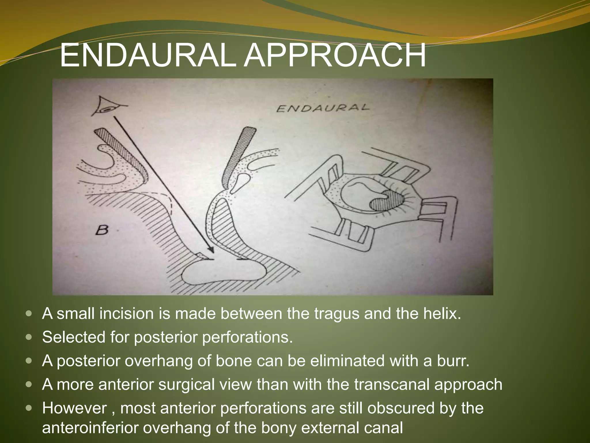 Tympanoplasty; Indications, types, anesthesia, surgical procedure. | PPT