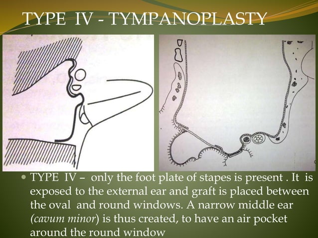 Tympanoplasty; Indications, types, anesthesia, surgical procedure.