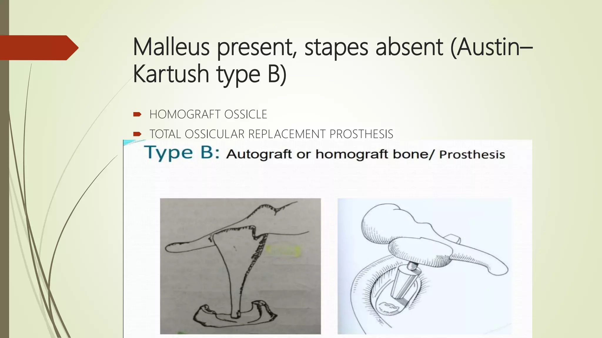 Tympanoplasty and ossiculoplasty | PPTX