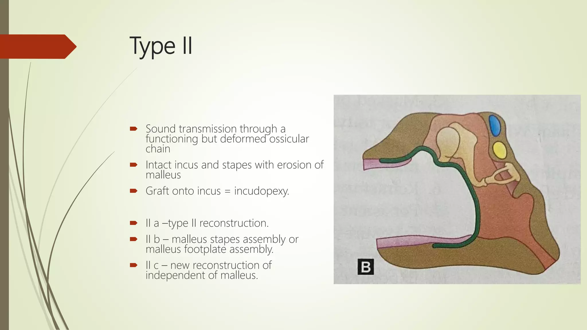 Tympanoplasty and ossiculoplasty | PPTX