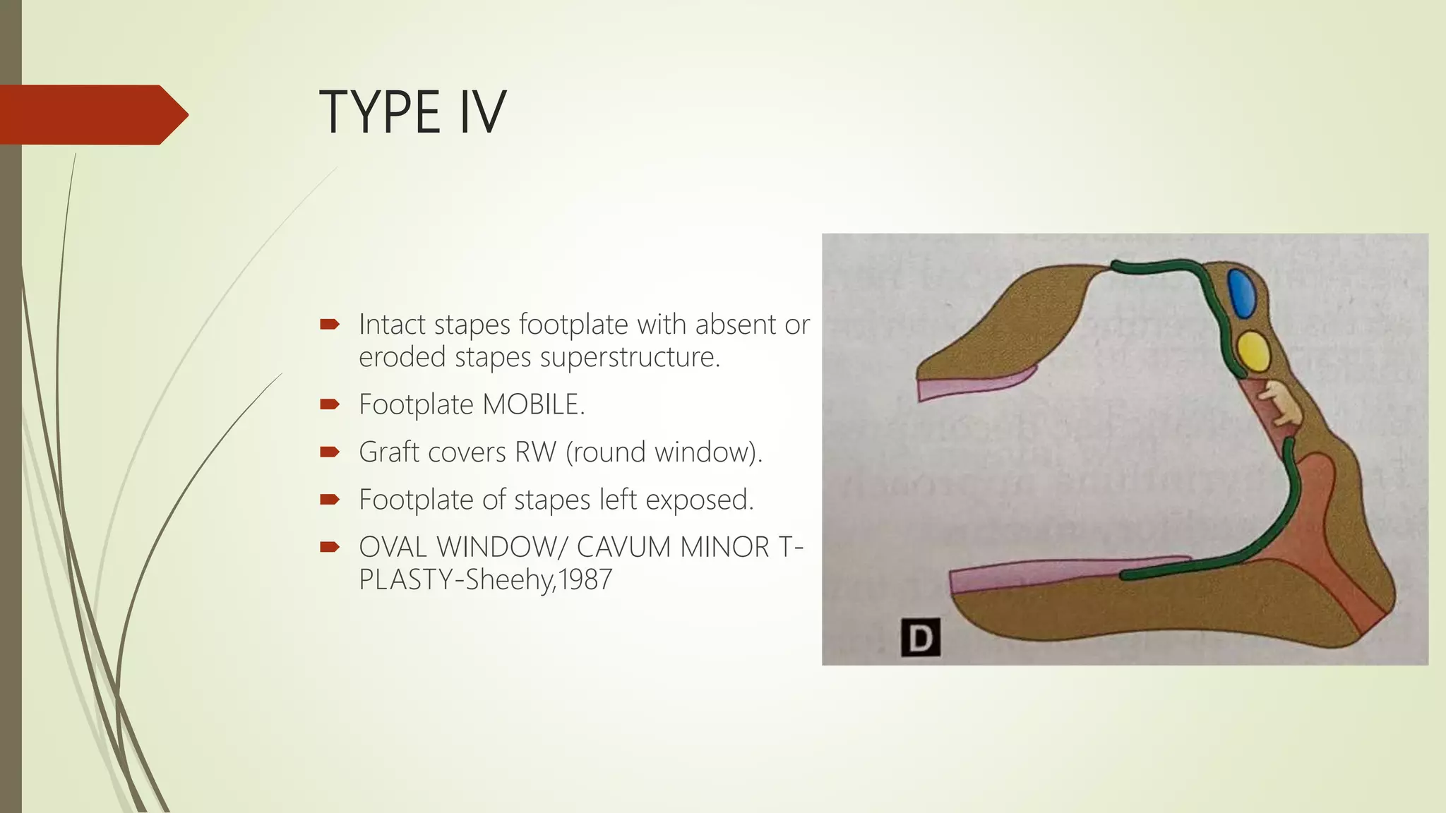 Tympanoplasty and ossiculoplasty | PPTX