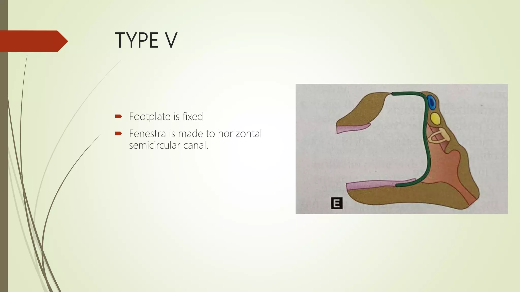 Tympanoplasty and ossiculoplasty | PPTX