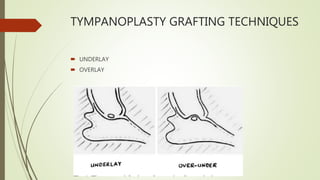 Tympanoplasty and ossiculoplasty | PPTX