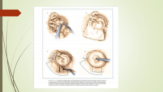 Tympanoplasty and ossiculoplasty | PPTX