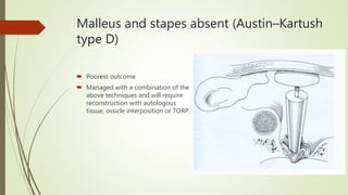 Tympanoplasty and ossiculoplasty | PPTX
