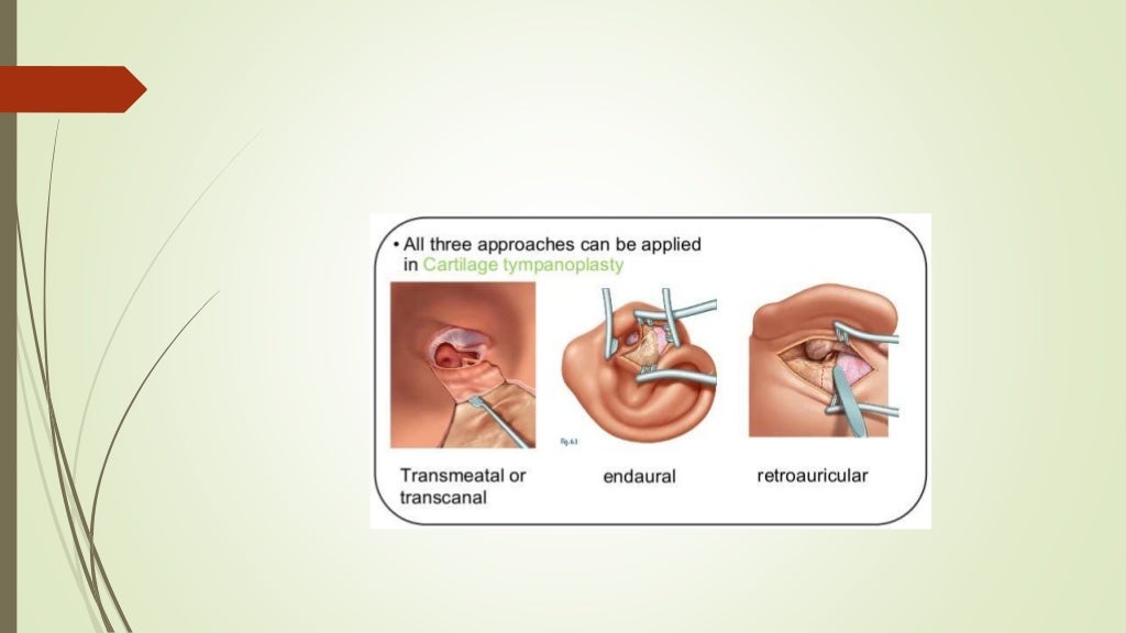 Tympanoplasty and ossiculoplasty