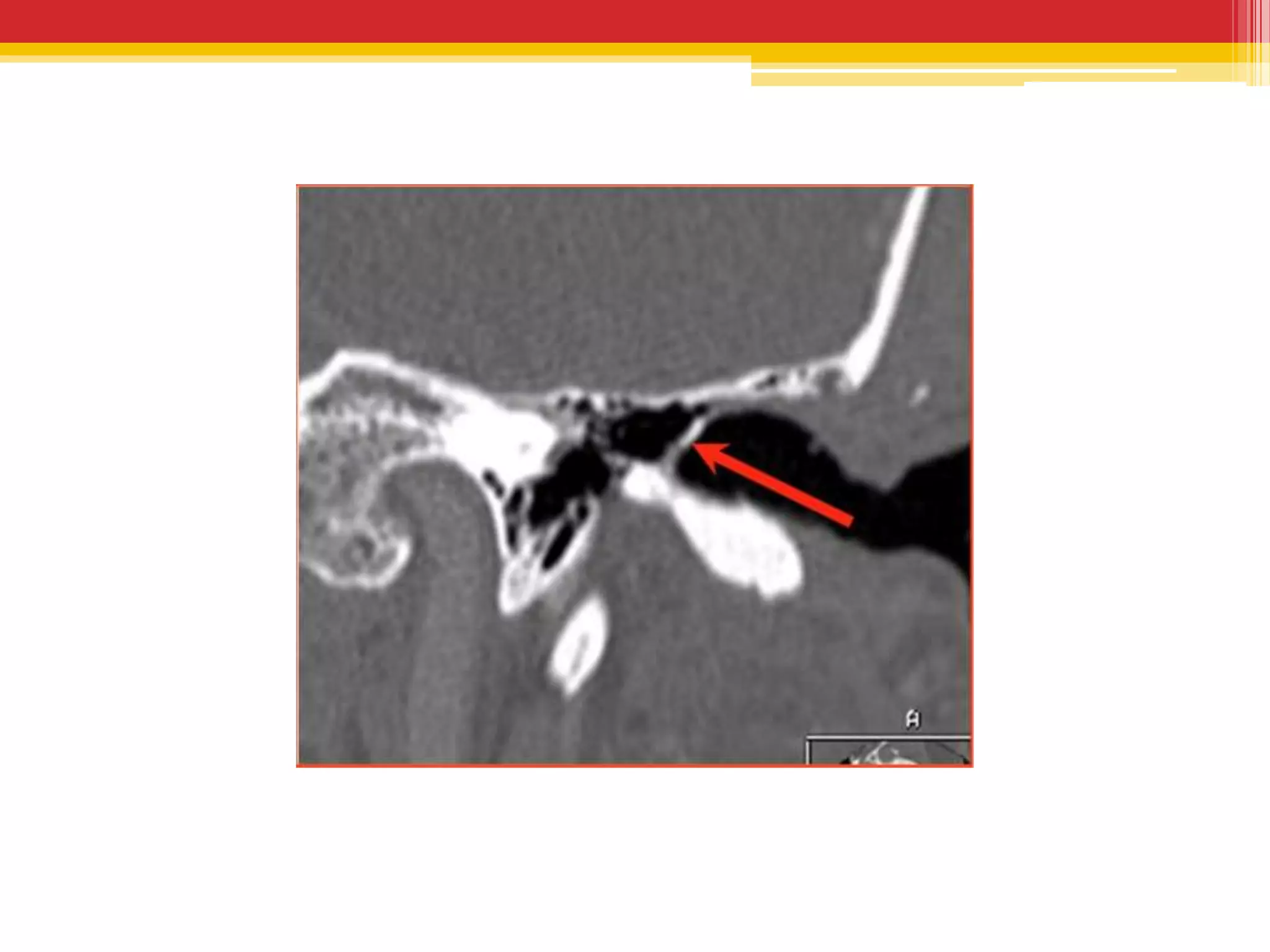 Tympanosclerosis | PPTX