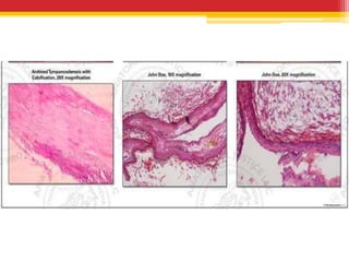 Tympanosclerosis | PPTX
