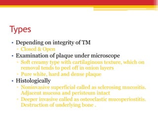 Tympanosclerosis | PPTX