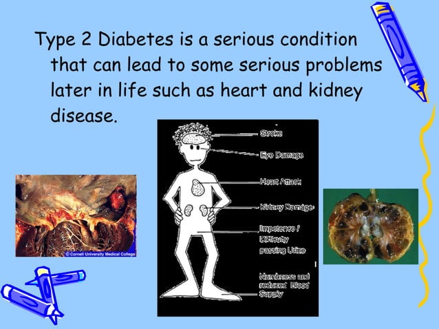 Type 2 Diabetes PPT | PPT