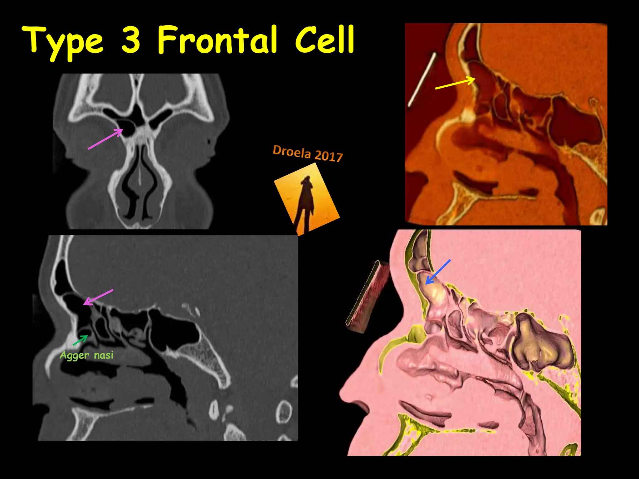 Type 3 Frontal Cell | PPT
