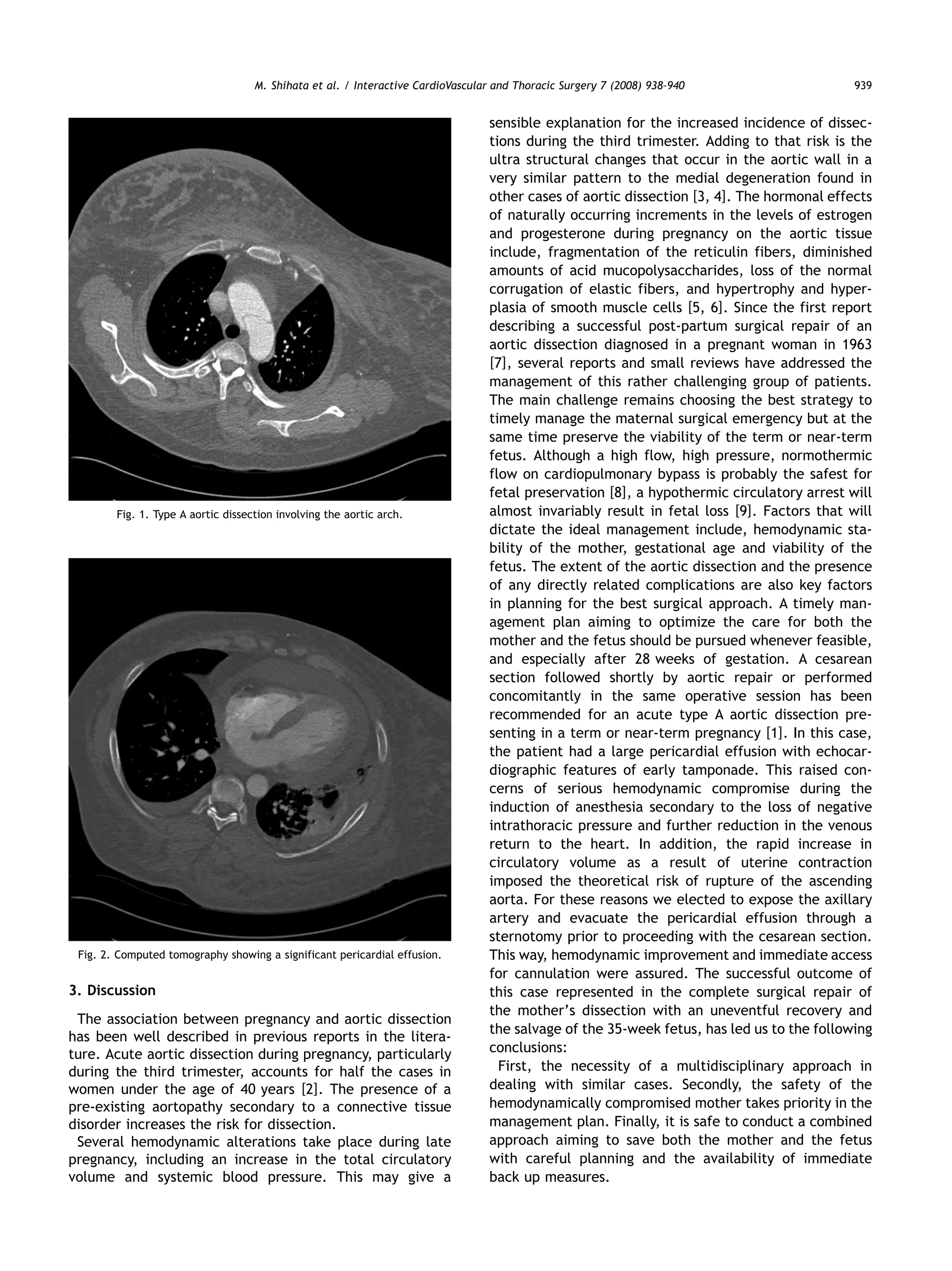 Type a dissection in pregnancy | PDF
