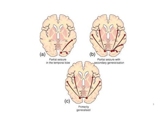Type and evaluation of seizures | PPT