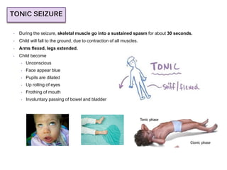 Type and evaluation of seizures | PPT