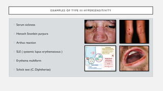Type II Hypersensitivity Reaction: Mechanism, Examples and Clinical ...