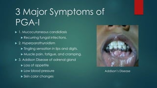 Type i polyglandular autoimmune syndrome | PPT