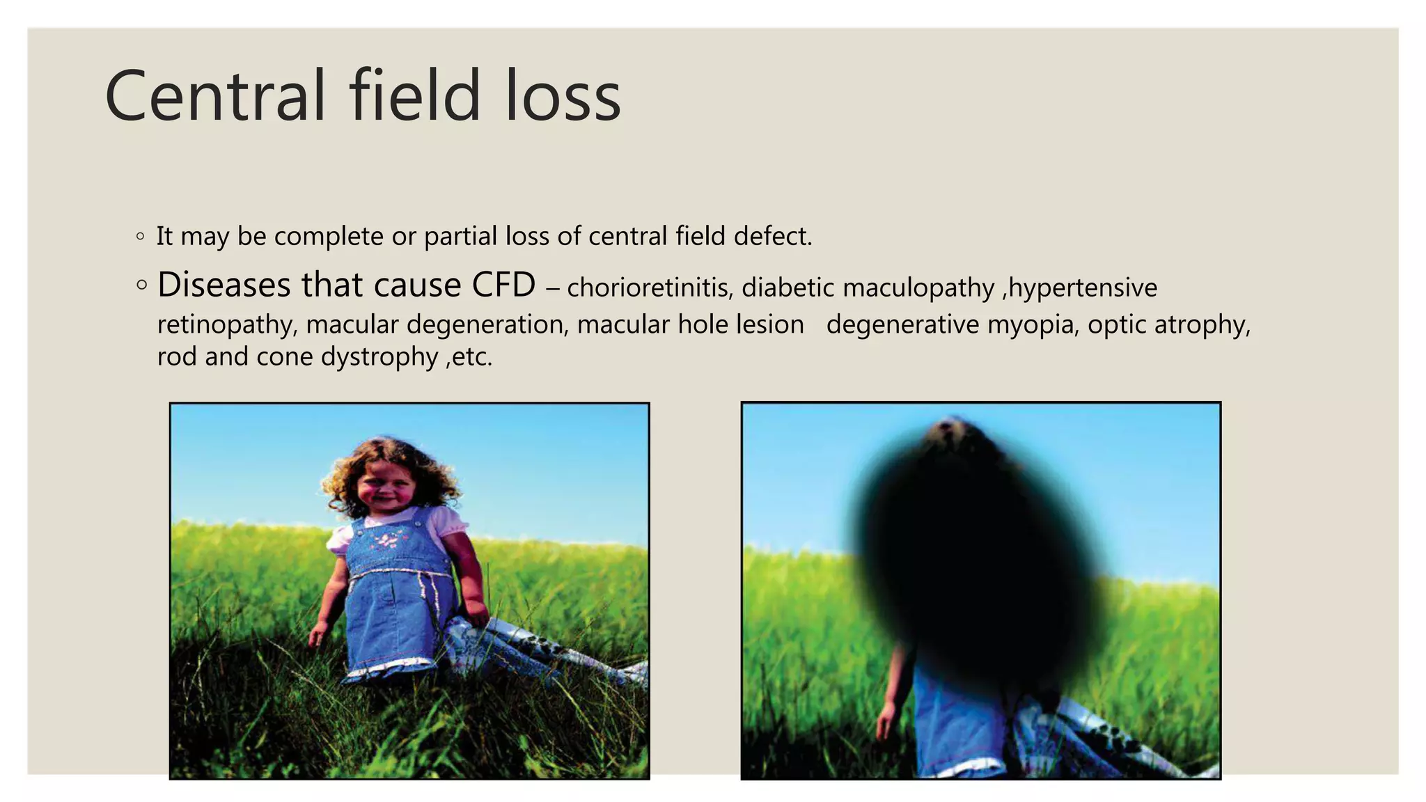 type of visual field defect. | PPTX