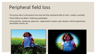 type of visual field defect. | PPTX