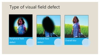 type of visual field defect. | PPTX