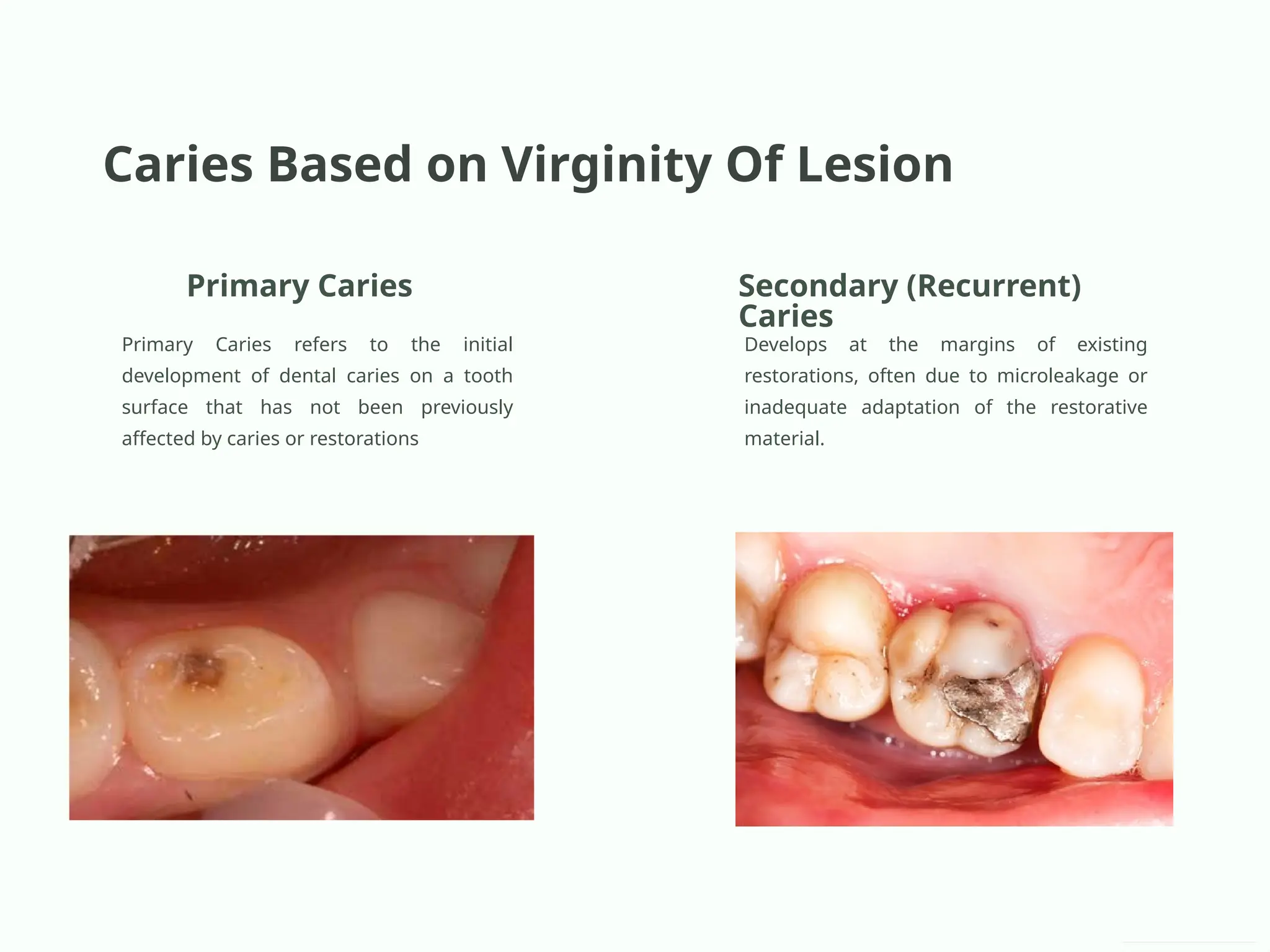 Types-of-Caries-and-Zones-of-Caries.pptx
