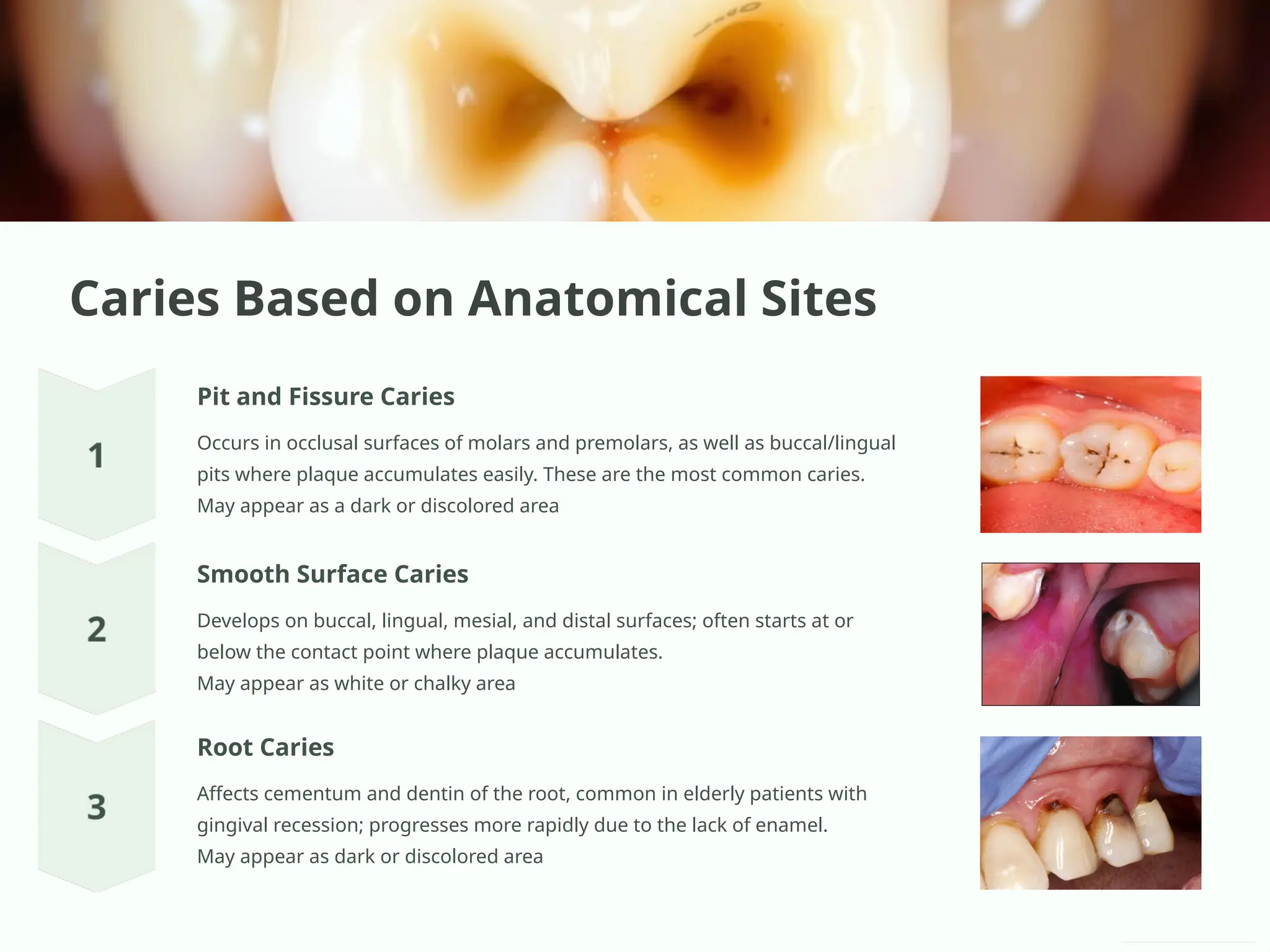 Types-of-Caries-and-Zones-of-Caries.pptx