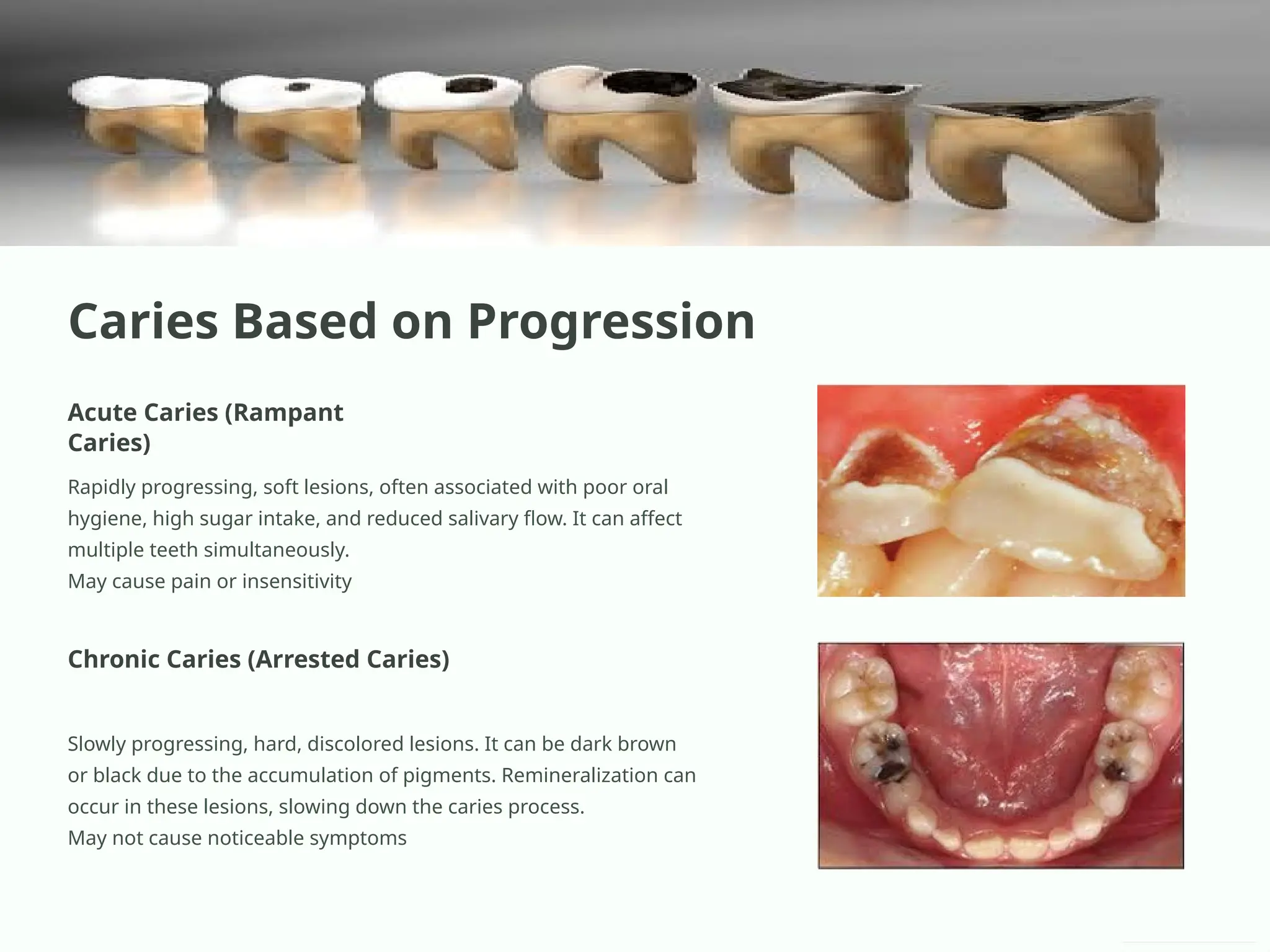 Types-of-Caries-and-Zones-of-Caries.pptx