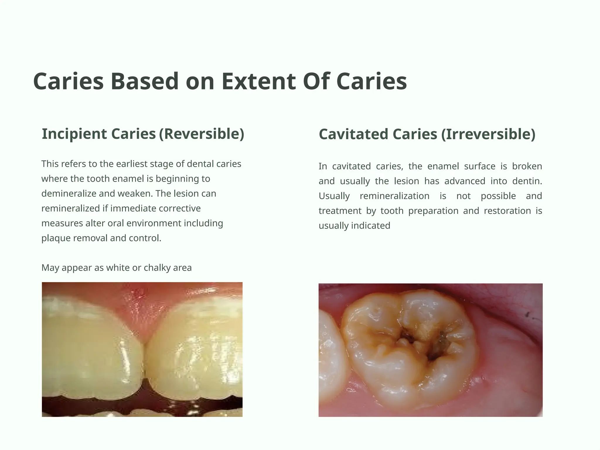 Types-of-Caries-and-Zones-of-Caries.pptx