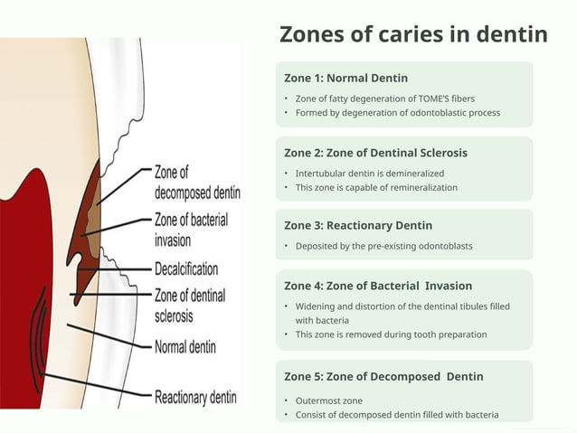 Types-of-Caries-and-Zones-of-Caries.pptx