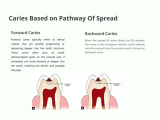 Types-of-Caries-and-Zones-of-Caries.pptx