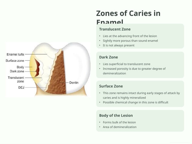 Types-of-Caries-and-Zones-of-Caries.pptx