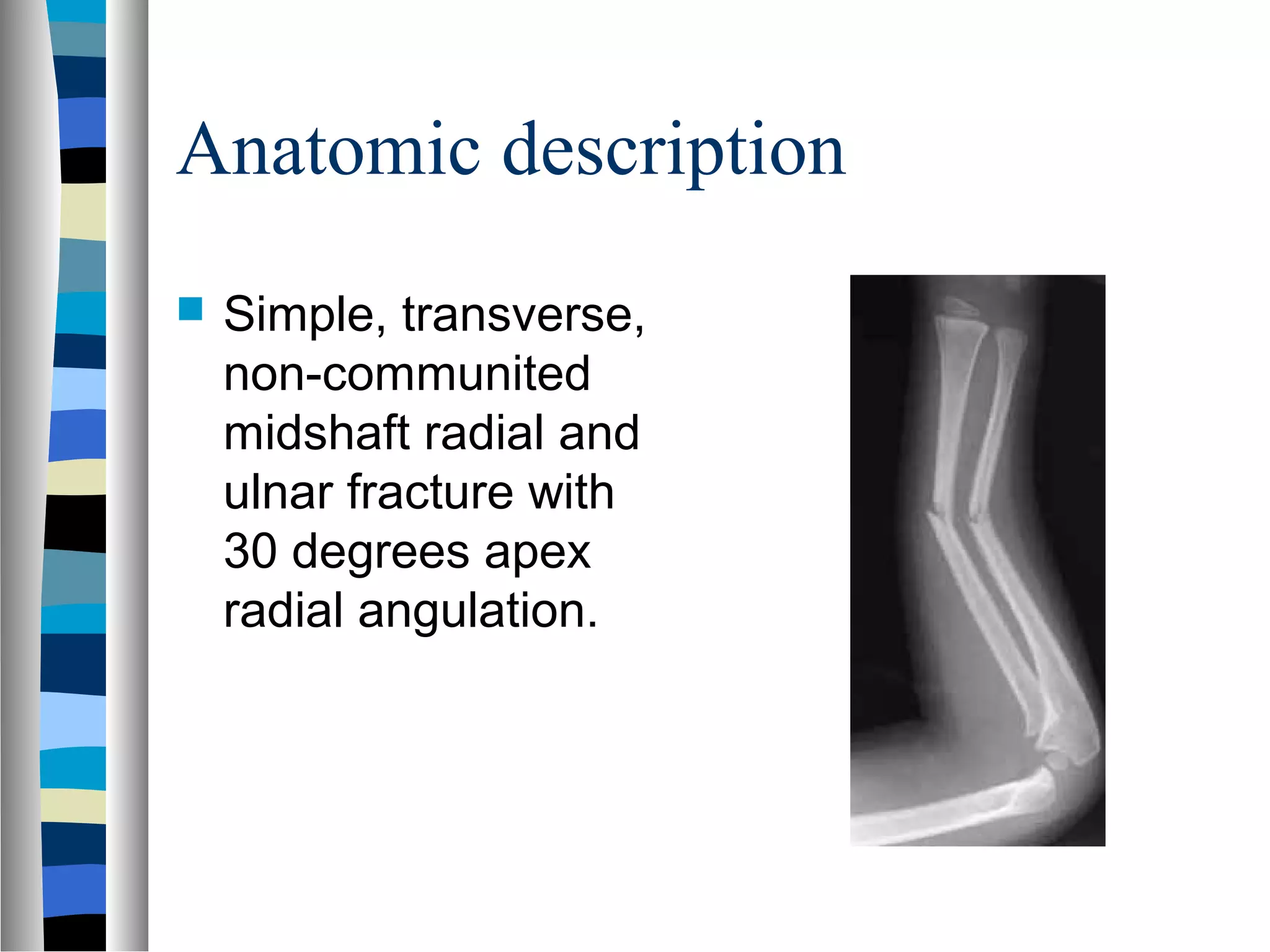 Types and classification of fractures | PPT