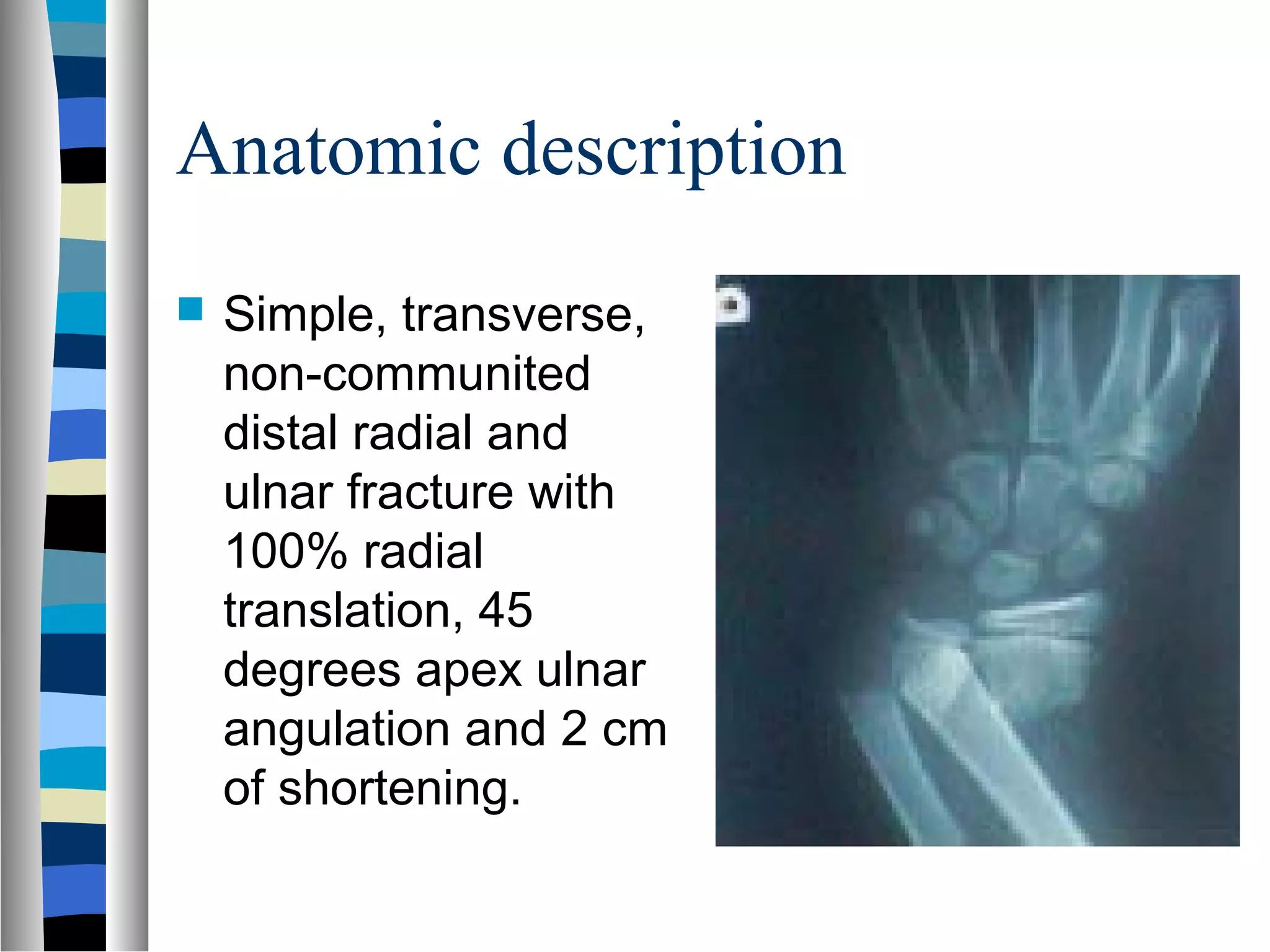 Types and classification of fractures | PPT