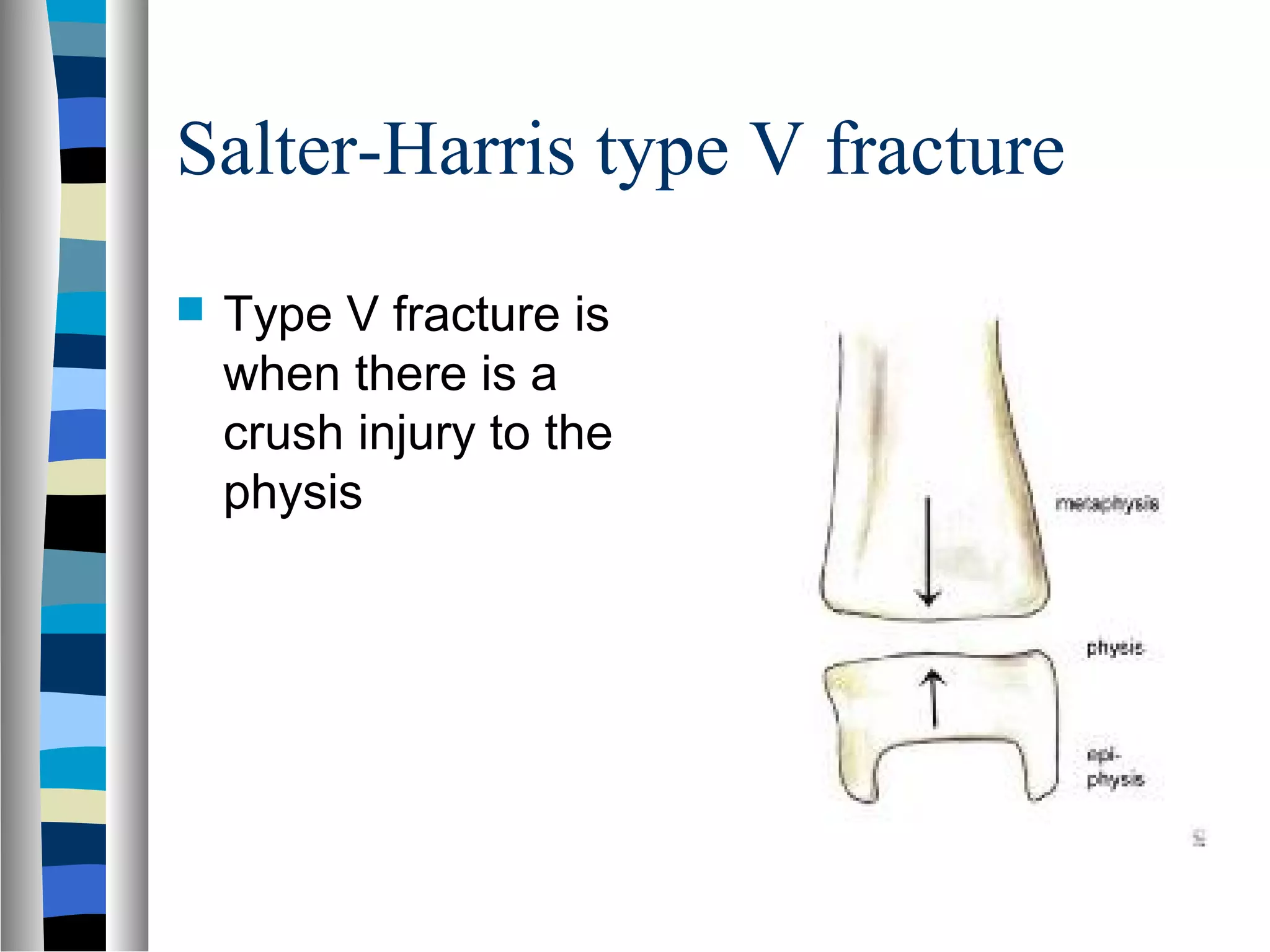 Types and classification of fractures | PPT