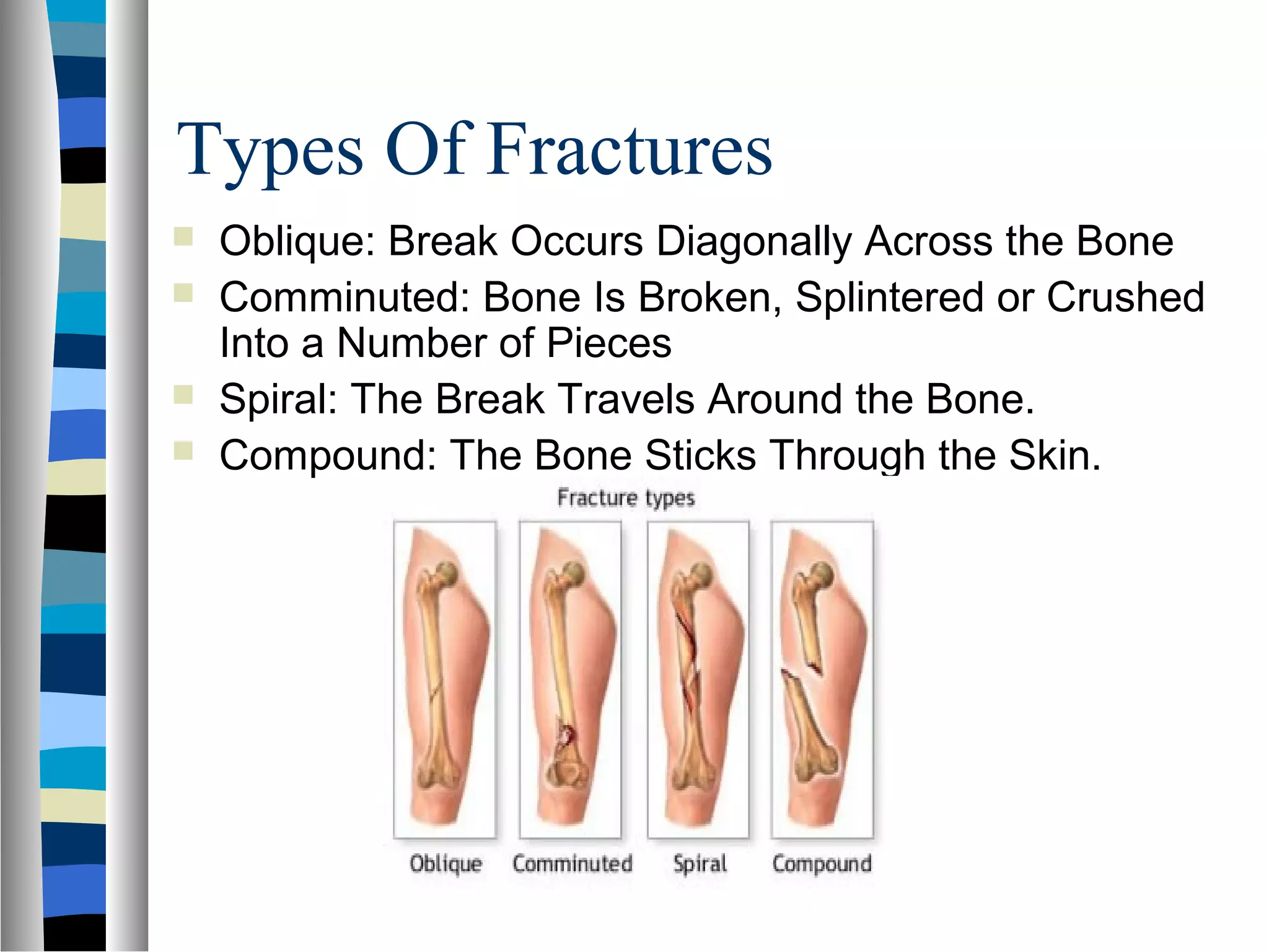 Types and classification of fractures | PPT