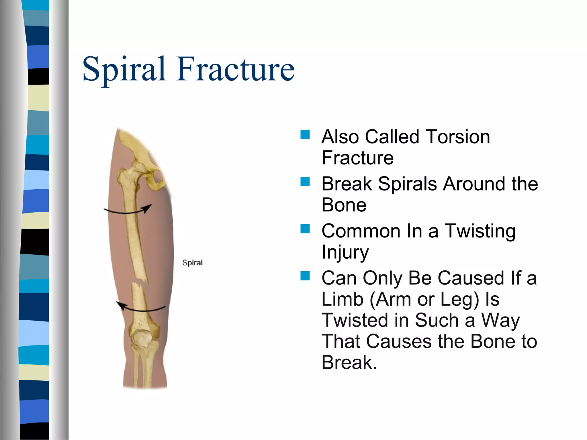 Types and classification of fractures | PPT