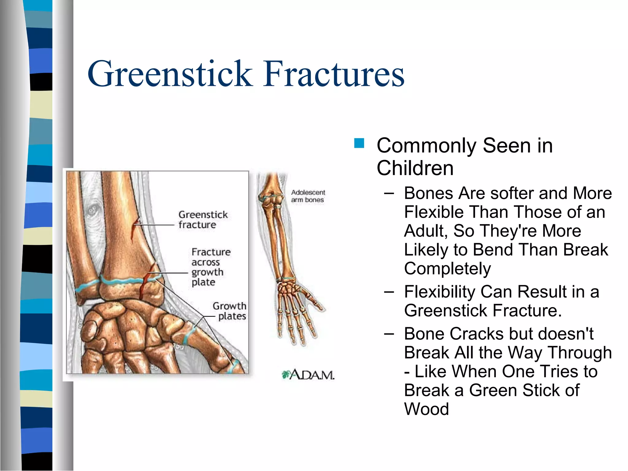 Types and classification of fractures | PPT