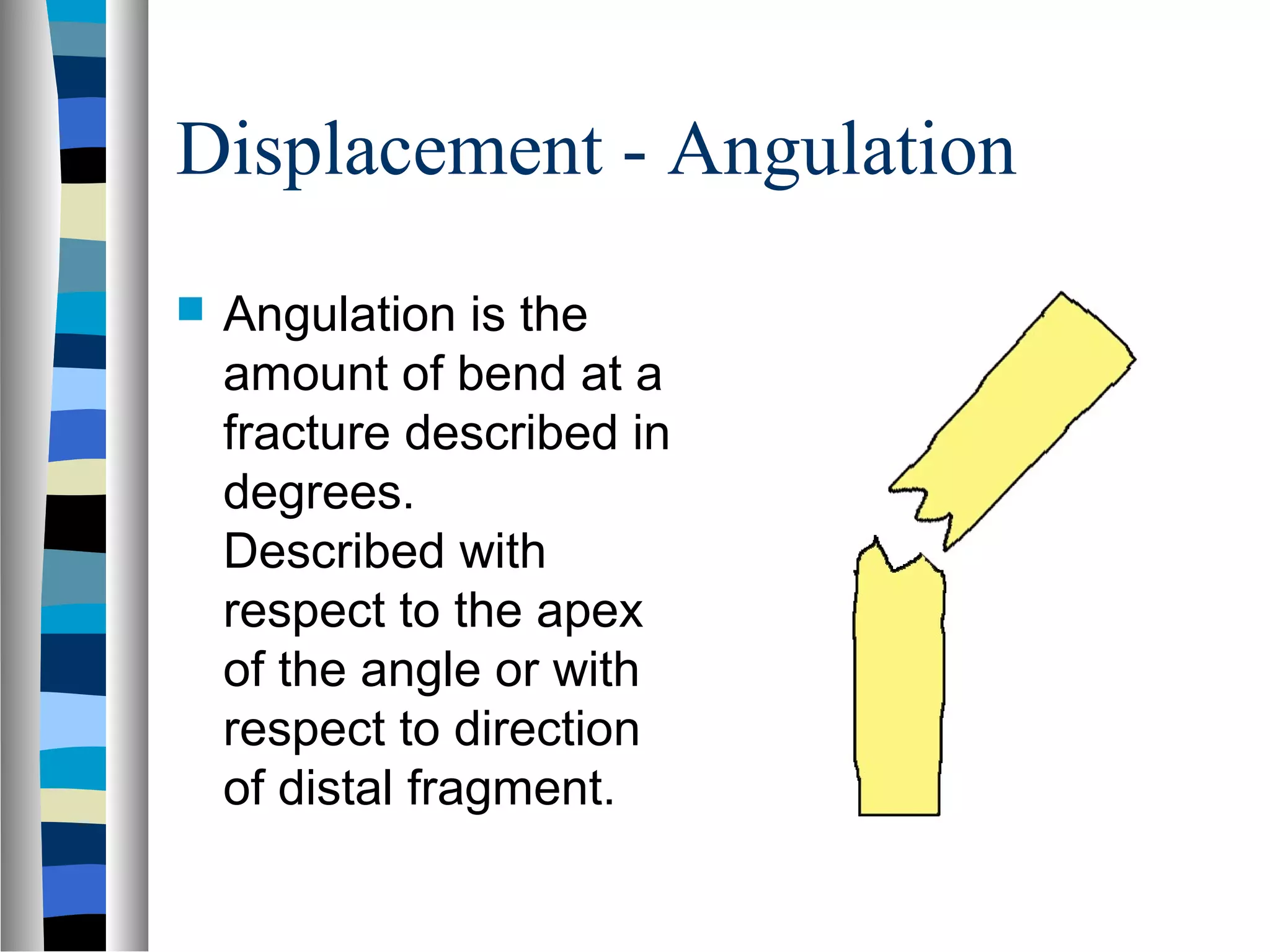 Types and classification of fractures | PPT