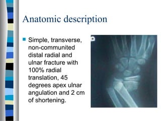 Types and classification of fractures | PPT