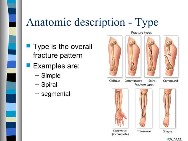 Types and classification of fractures | PPT