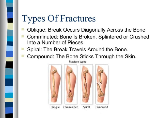 Types and classification of fractures | PPT