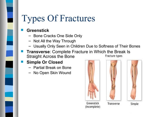 Types and classification of fractures | PPT
