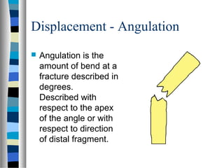 Types and classification of fractures | PPT