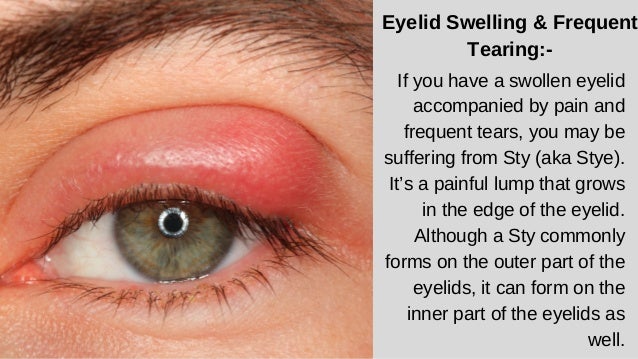 Types And Symptoms Of Eye Infection types-and-symptoms-of-eye-infection