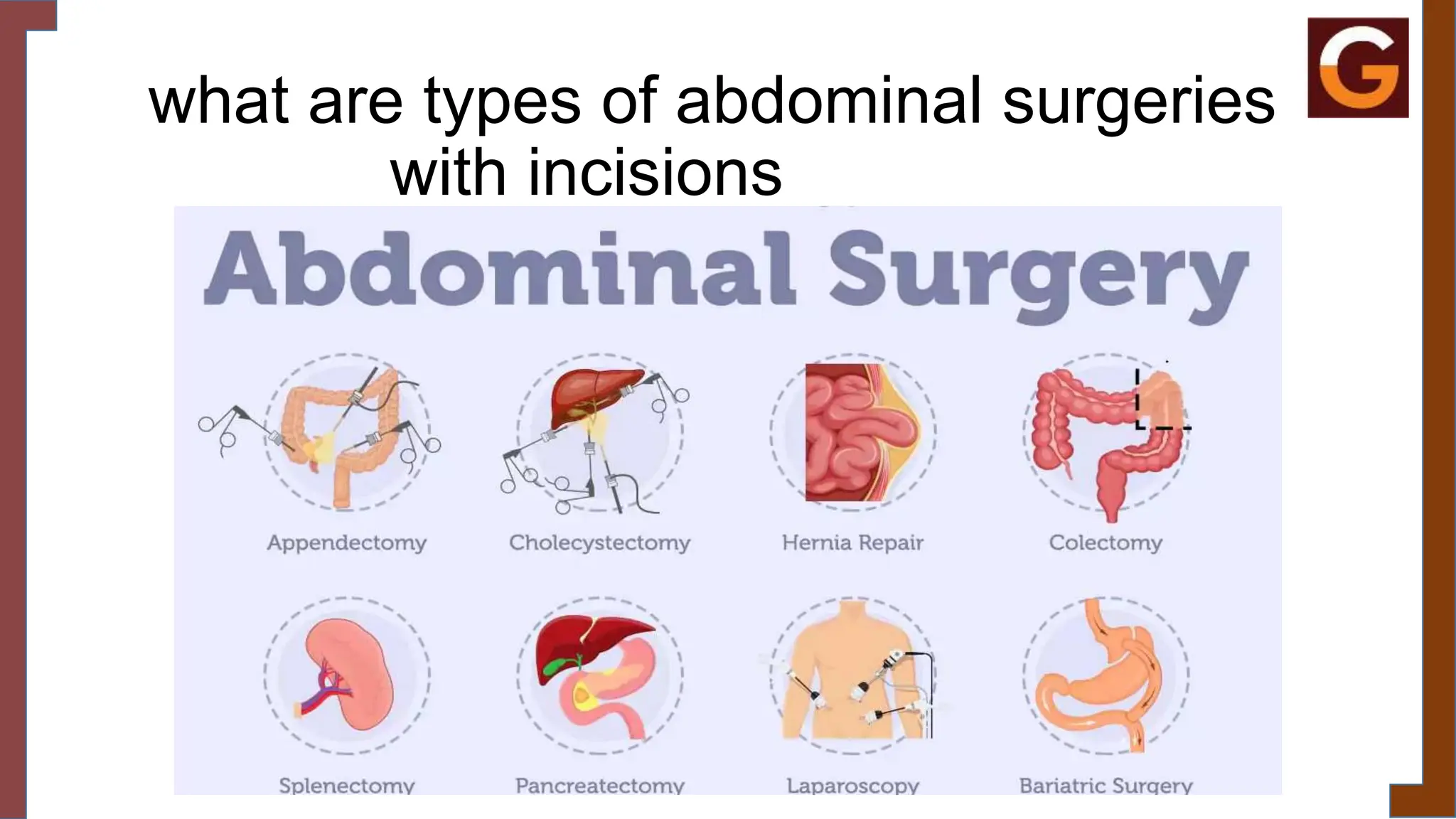 Types of abdominal surgeries and types of abdominal incisions.pptx