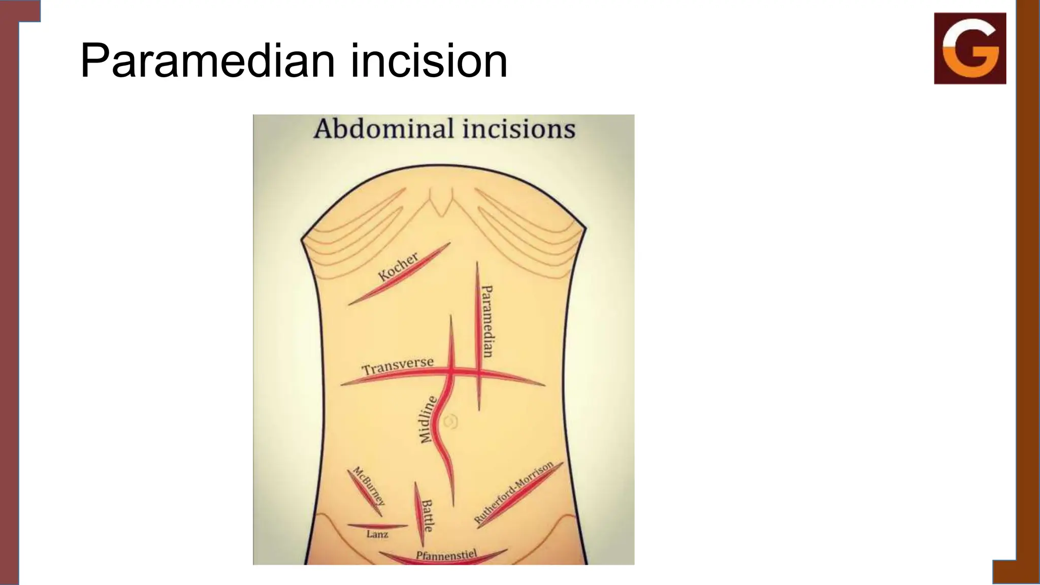 Types of abdominal surgeries and types of abdominal incisions.pptx